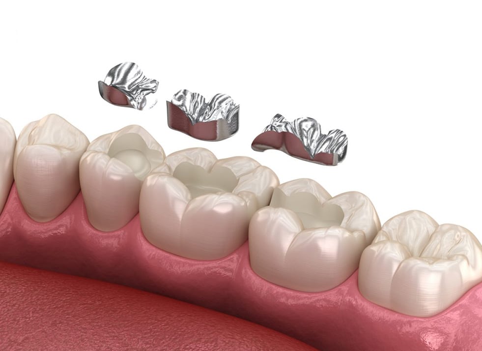 Dental Sealants In Richmond TX - Inspire Smiles