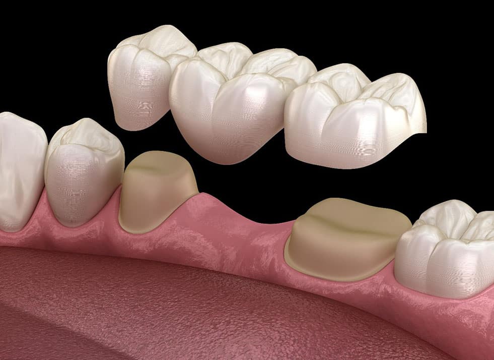 Dental Crowns In Richmond, TX - Inspire Smiles